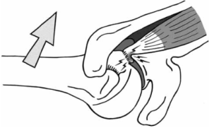 Impingement (SAPS) | JC Physiotherapy