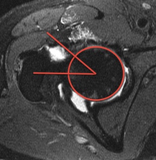 Hip Alpha Angle | JC Physiotherapy